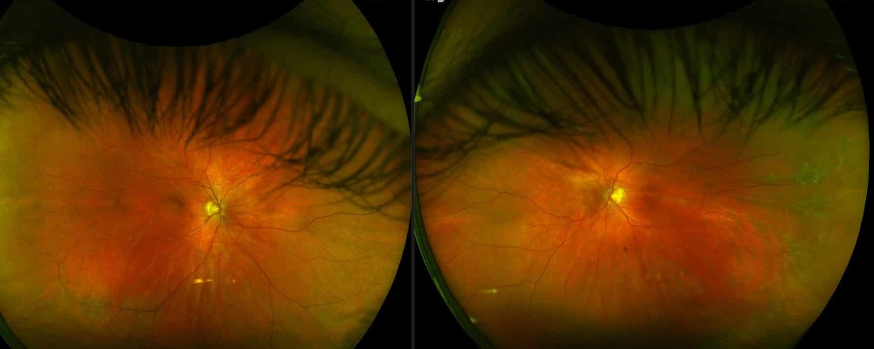 Retinal Care - Omni Eye Services of Atlanta - Laser Cataract Surgery ...